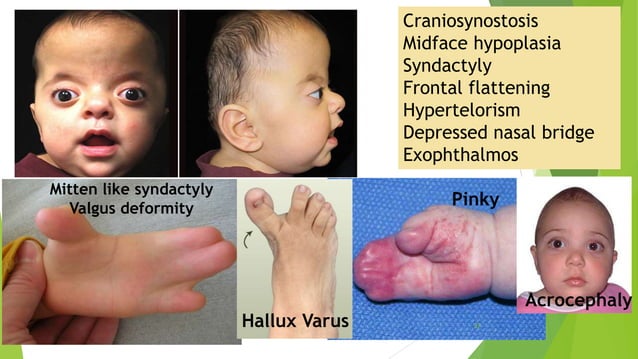 Syndromes of orofacial region mine | PPTX | Ear, Nose and Throat ...