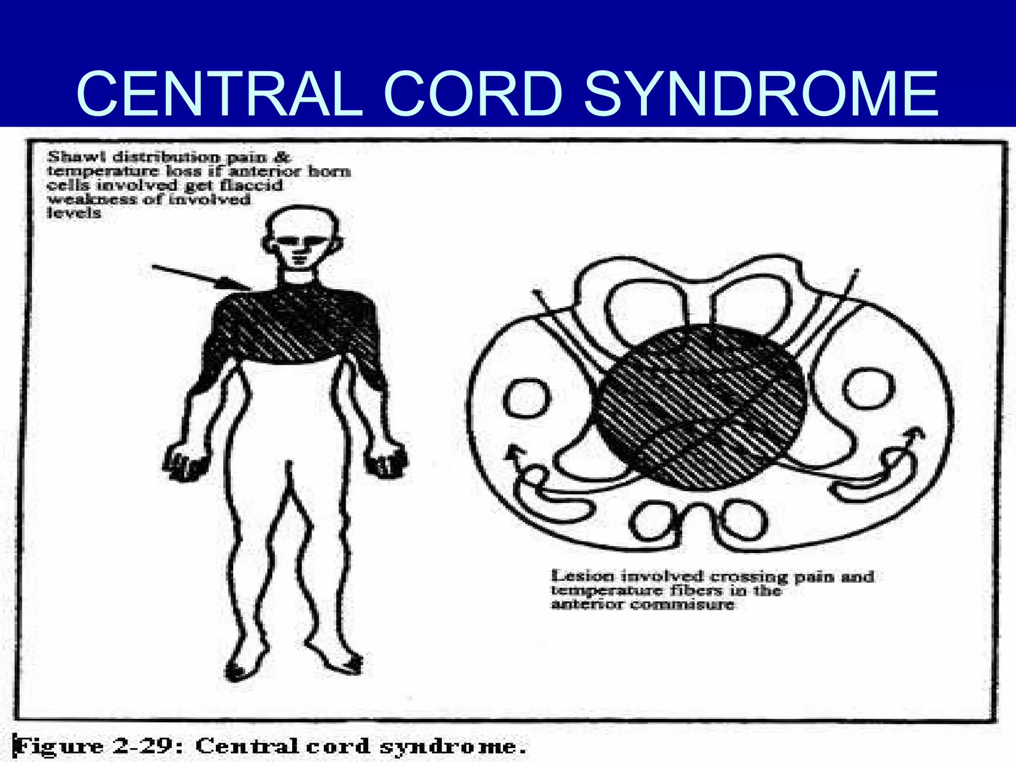 Syndromes Of Spinal Cord | PPT