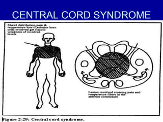 Syndromes Of Spinal Cord Ppt