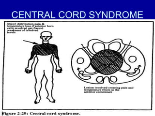 Clinical Syndromes of spinal cord lesions | PPT