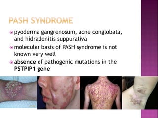 Syndromic Acne | PPTX