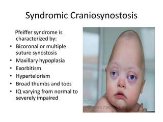 Syndromic cranial synostosis | PPTX
