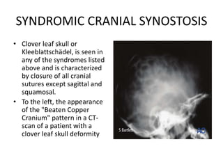 Syndromic cranial synostosis | PPTX