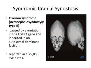 Syndromic cranial synostosis | PPTX