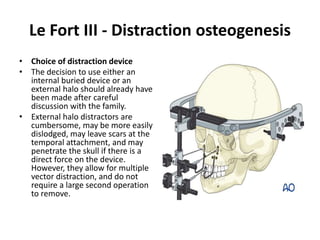 Syndromic cranial synostosis | PPTX