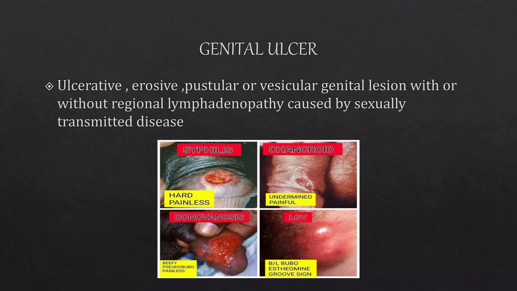 SYNDROMIC MANAGEMENT OF GENITAL ULCERS.pptx