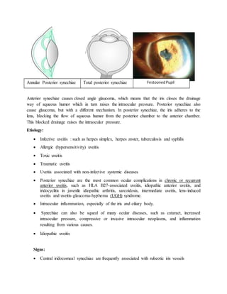 Anterior Vs Posterior Synechiae