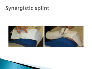 synergist splint for flexor tendon repair | PPT