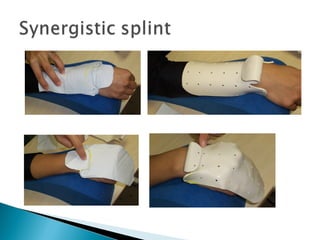 synergist splint for flexor tendon repair | PPT