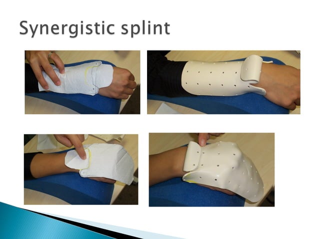 synergist splint for flexor tendon repair | PPT