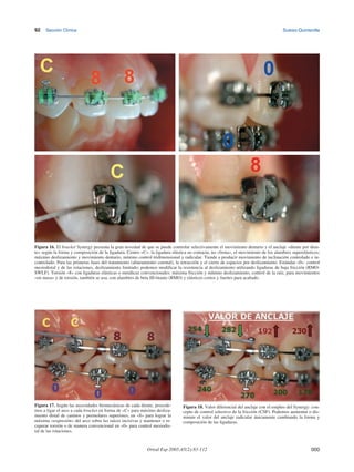 brackets Synergy swlf | PDF