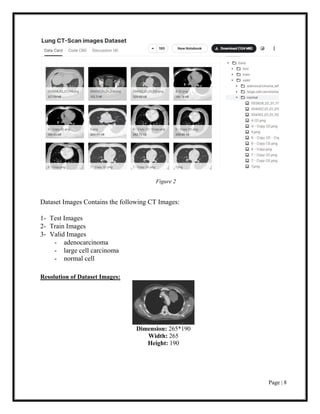 Lung Tumour Detection using Image Processing | PDF