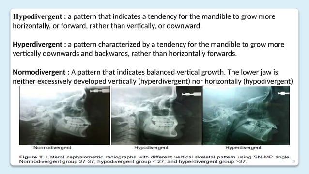 mandibular molar distalization SYNOPSIS PPT.pptx