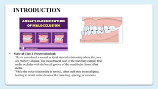mandibular molar distalization SYNOPSIS PPT.pptx