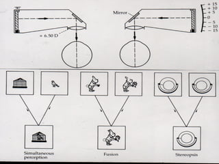 Synoptophore 2 | PPT
