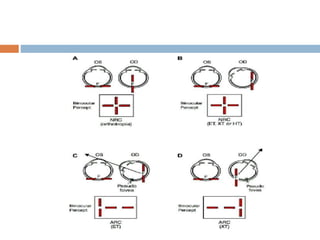 Synoptophore | Major amblyoscope | PPT