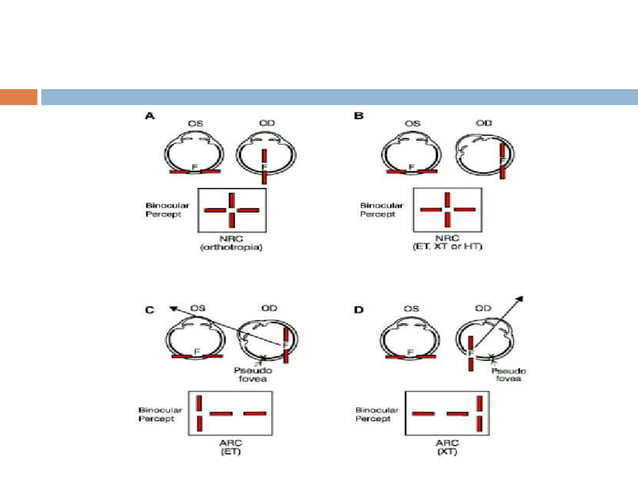 Synoptophore | Major amblyoscope | PPT | Eye and Vision Conditions ...