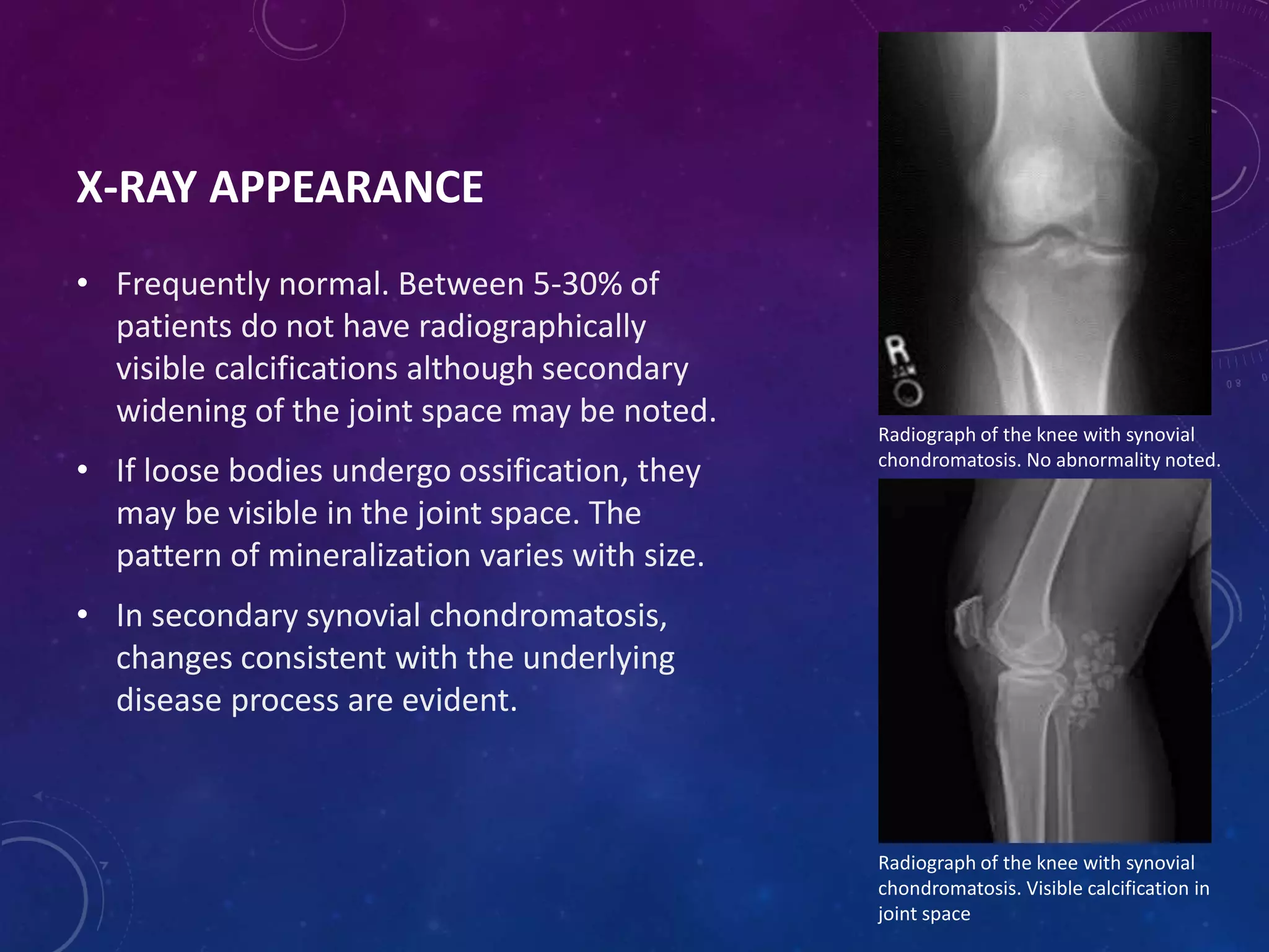 Synovial chondromatosis | PPTX