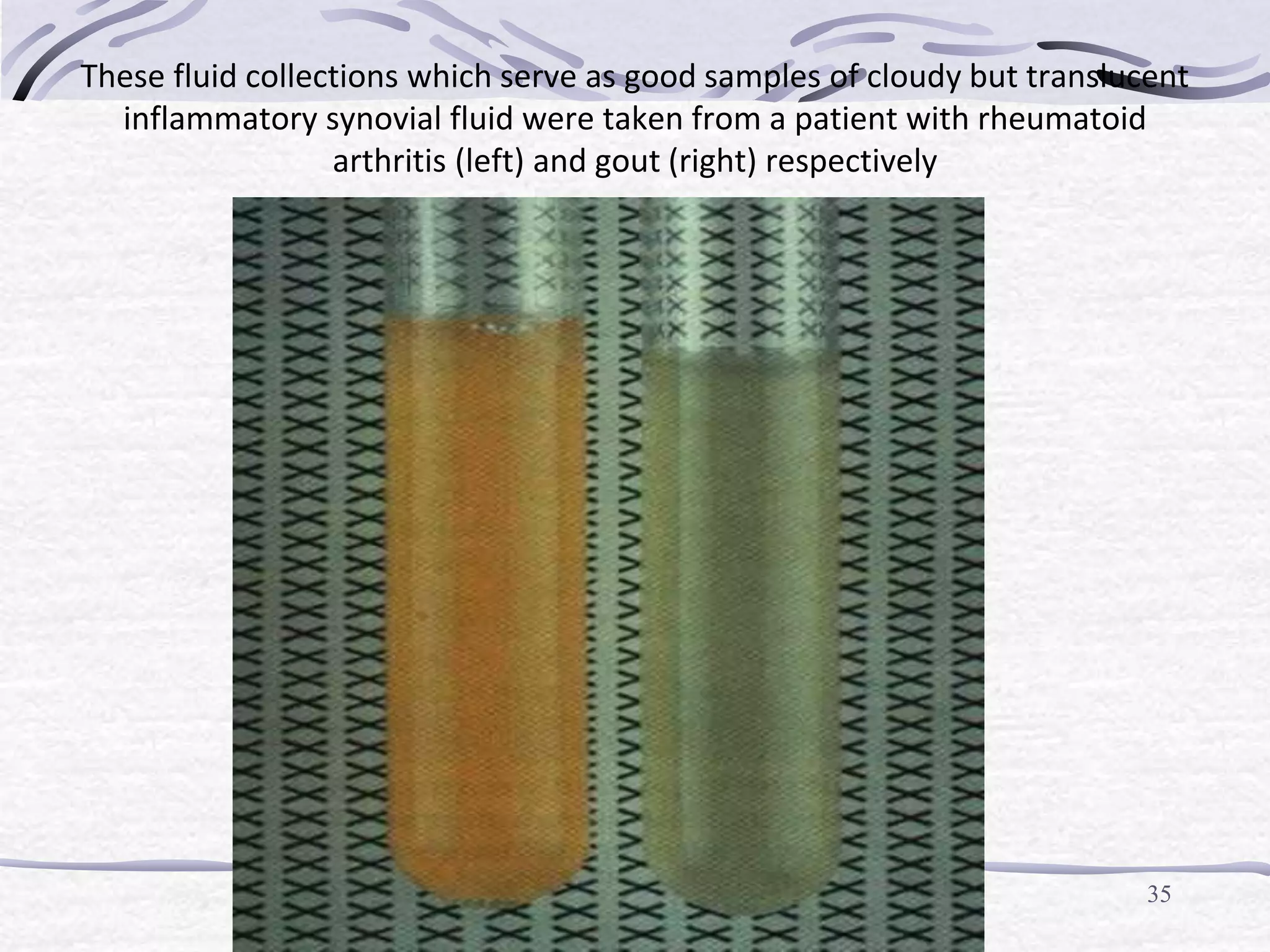 Clinical applications of Synovial (joint ) fluid analysis Dr.Sandeep C ...