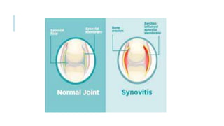 SYNOVITIS.pptx