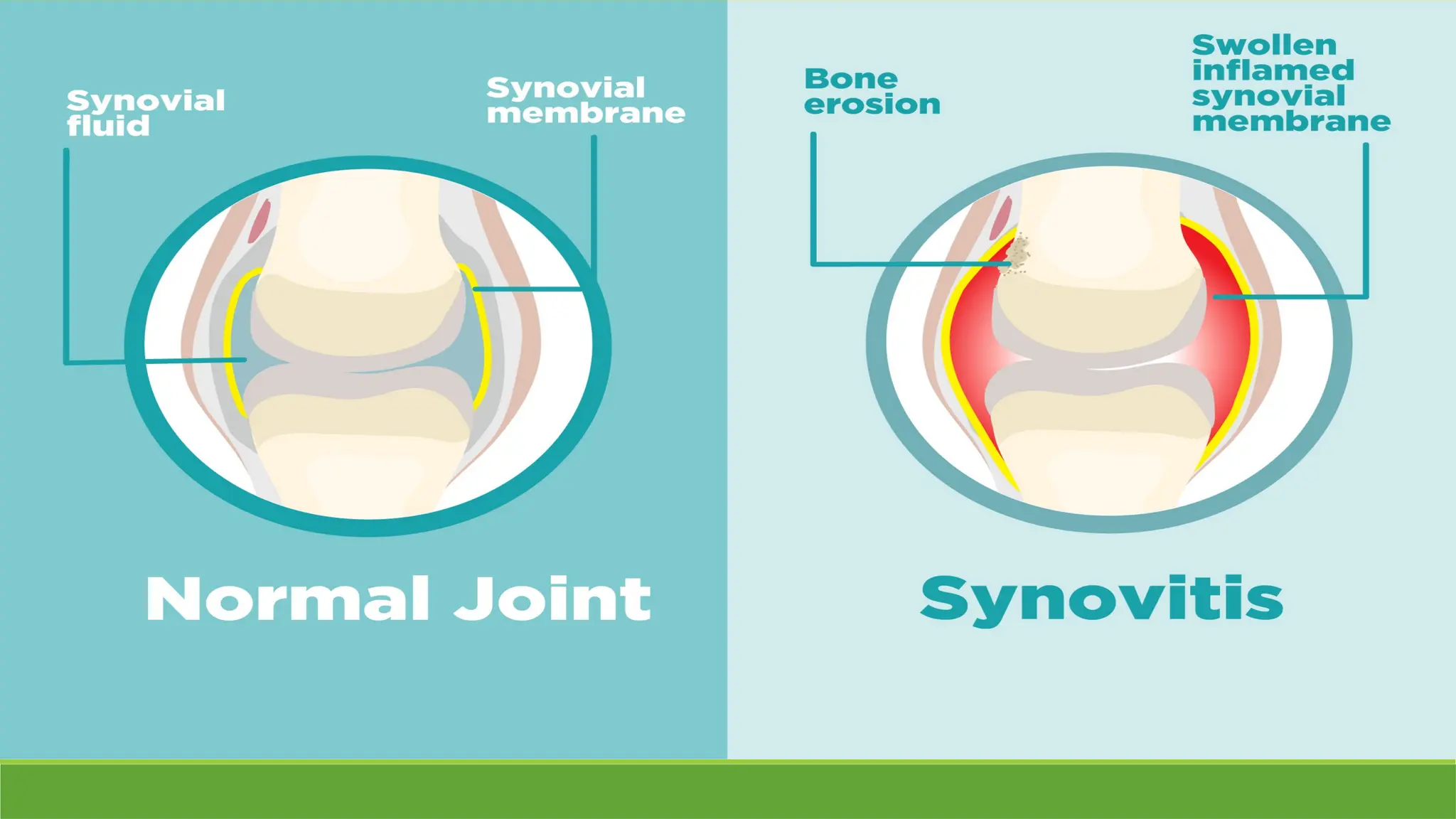 SYNOVITIS.DEFINITION ,CAUSES ,SYMPTOMS AND TREATMENT | PPTX