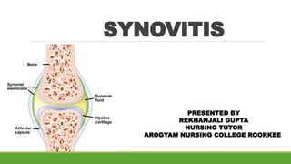 SYNOVITIS.DEFINITION ,CAUSES ,SYMPTOMS AND TREATMENT | PPTX