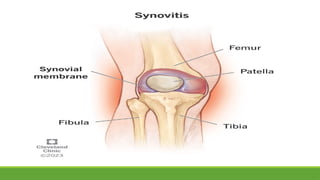 SYNOVITIS.DEFINITION ,CAUSES ,SYMPTOMS AND TREATMENT | PPTX