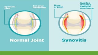 SYNOVITIS.DEFINITION ,CAUSES ,SYMPTOMS AND TREATMENT | PPTX