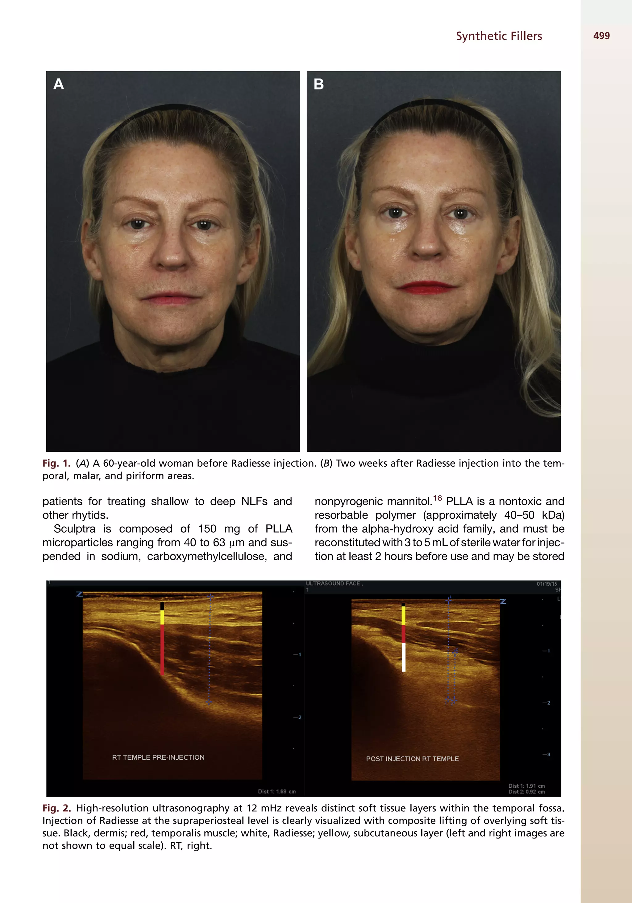 Synthetic fillers for facial rejuvenation | PDF