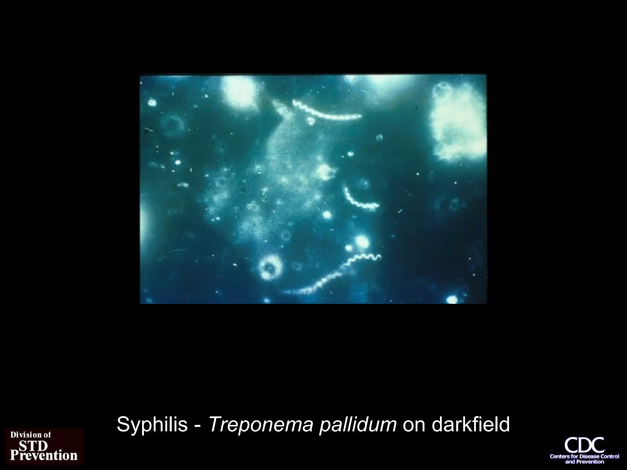 Syphilis