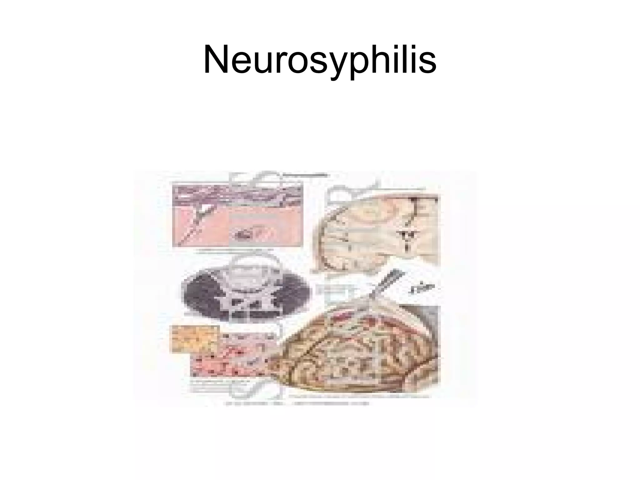 Syphilis and Neurosyphilis 101 | PPT