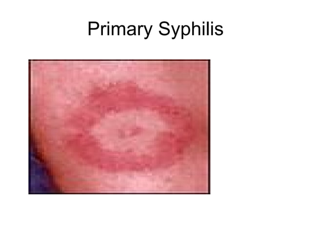 Syphilis and Neurosyphilis 101 | PPT | Brain and Nervous System ...