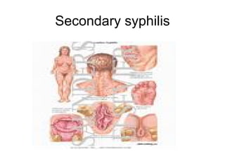 Syphilis and Neurosyphilis 101 | PPT