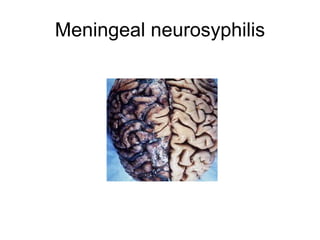 Neurosyphilis