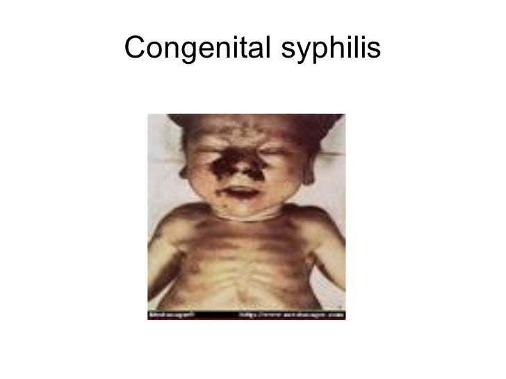 Syphilis and Neurosyphilis 101