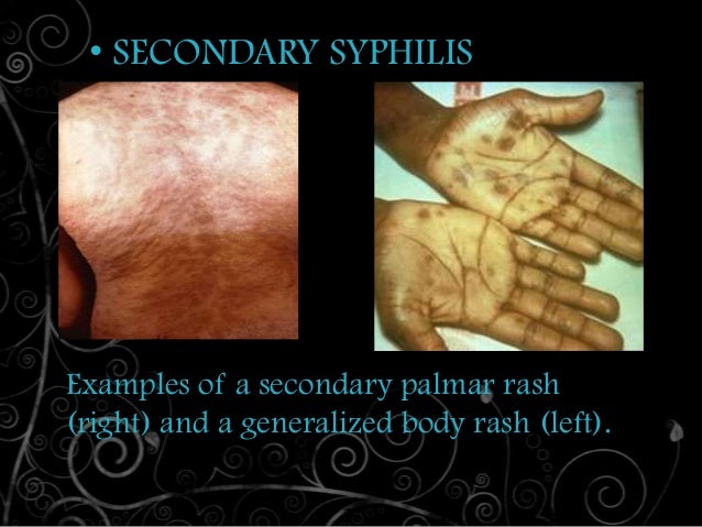 Syphilis (Disease)