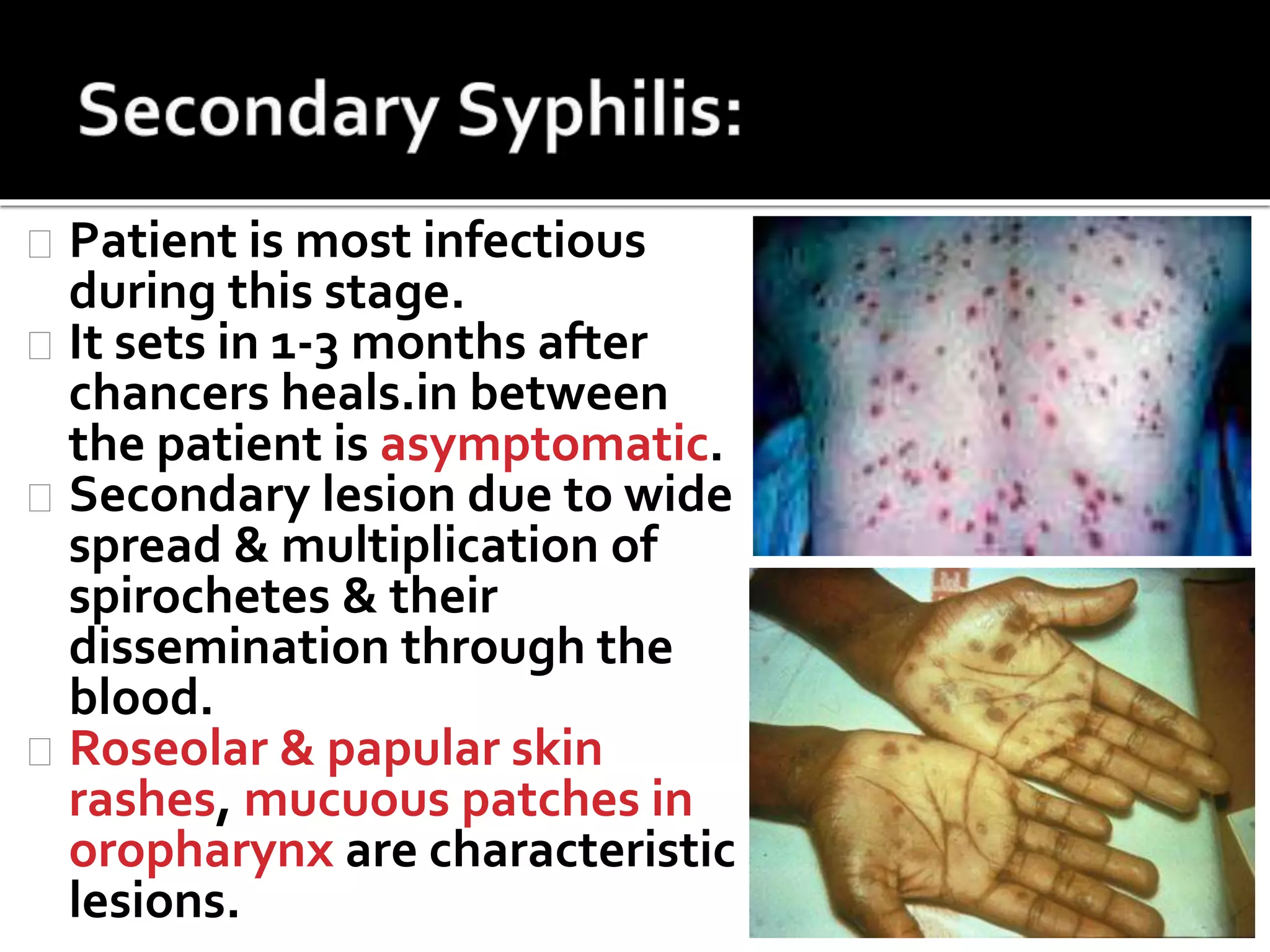 Syphilis | PPTX