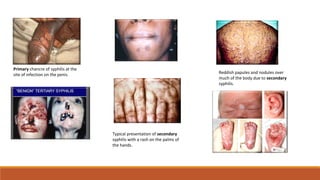 Syphilis | PPT