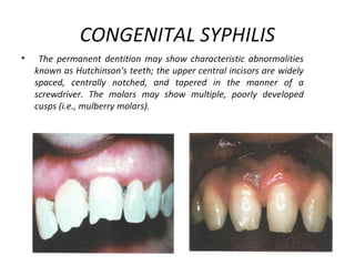 Congenital Syphilis Mulberry Molars