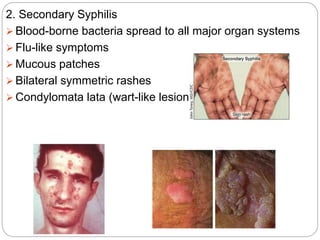 Syphilis | PPT