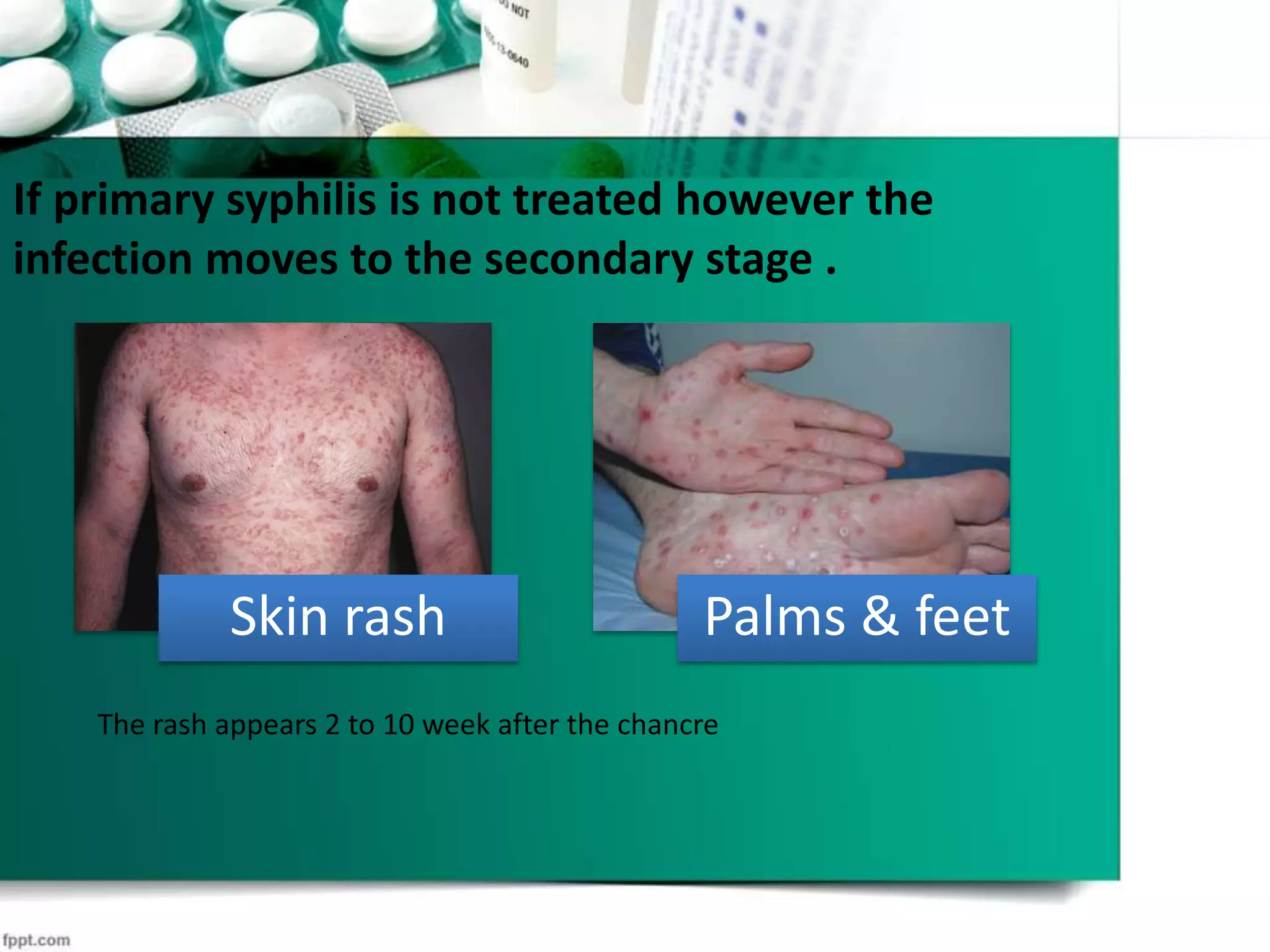 Syphilis | PPTX