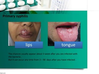 Syphilis | PPTX