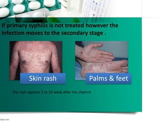 Syphilis | PPTX