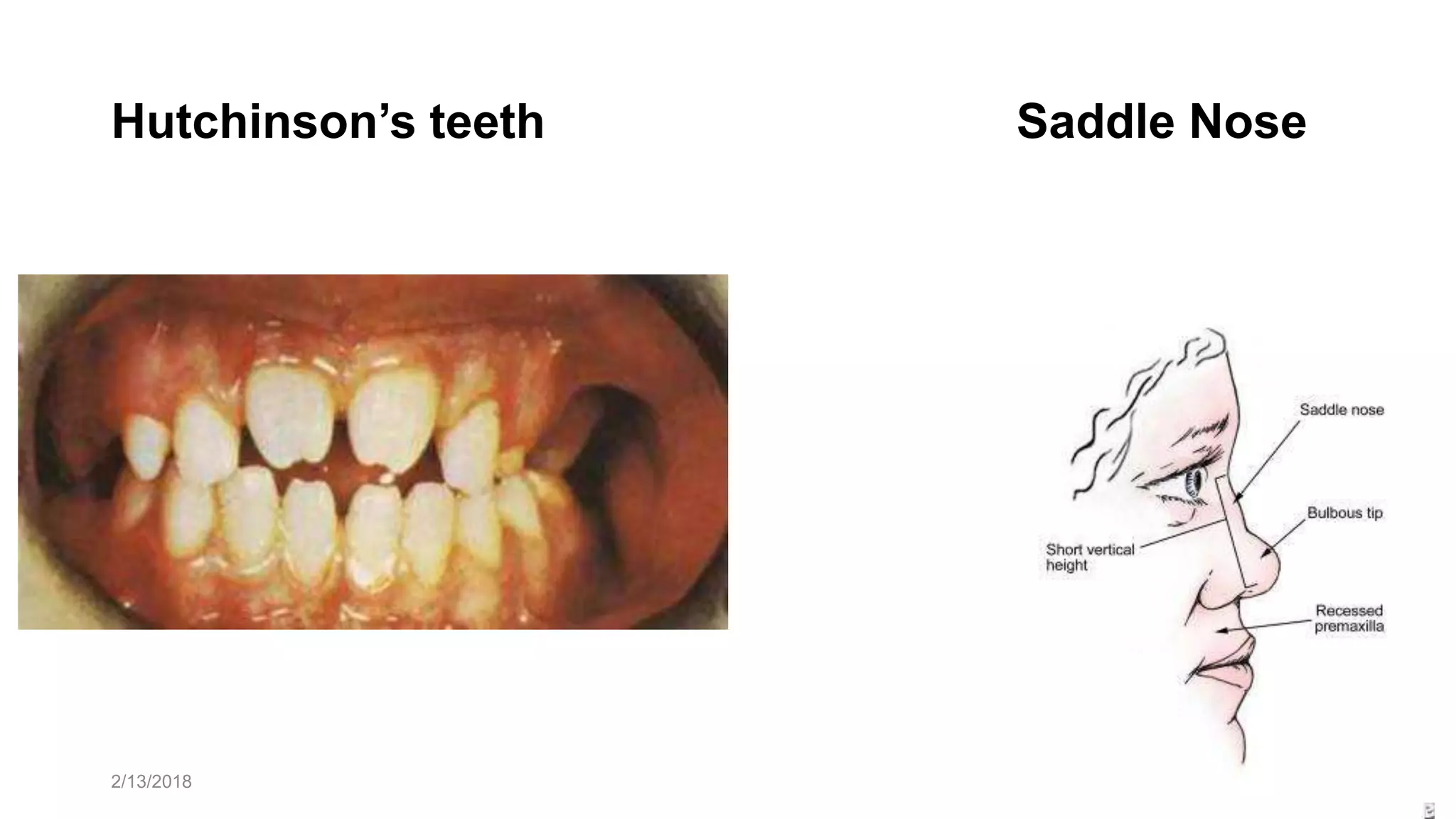Syphilis | PPTX