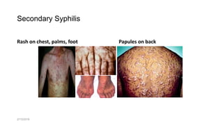 Syphilis | PPTX