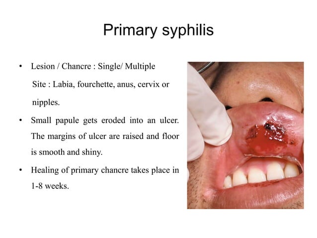 syphilis.pptx