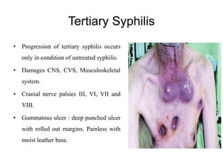syphilis.pptx