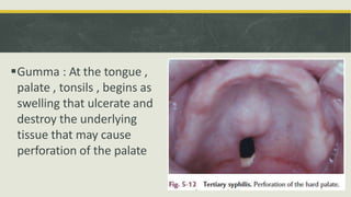 syphilis.pptx