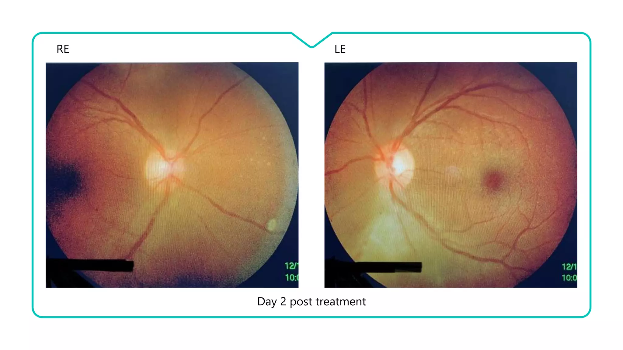 syphilis.pptx | Eye and Vision Conditions | Diseases and Conditions