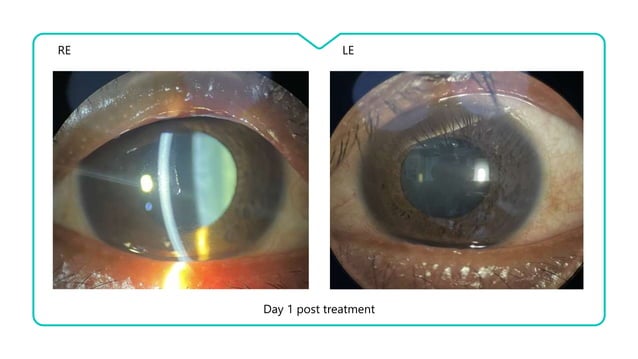 syphilis.pptx | Eye and Vision Conditions | Diseases and Conditions